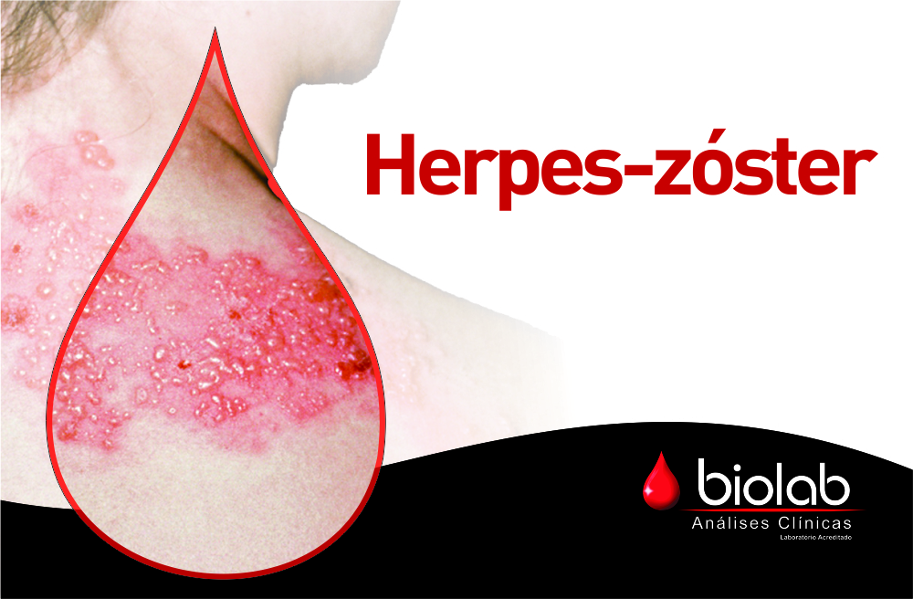 Saiba mais sobre o Herpes-zóster - Dicas de saúde - Laboratório Biolab